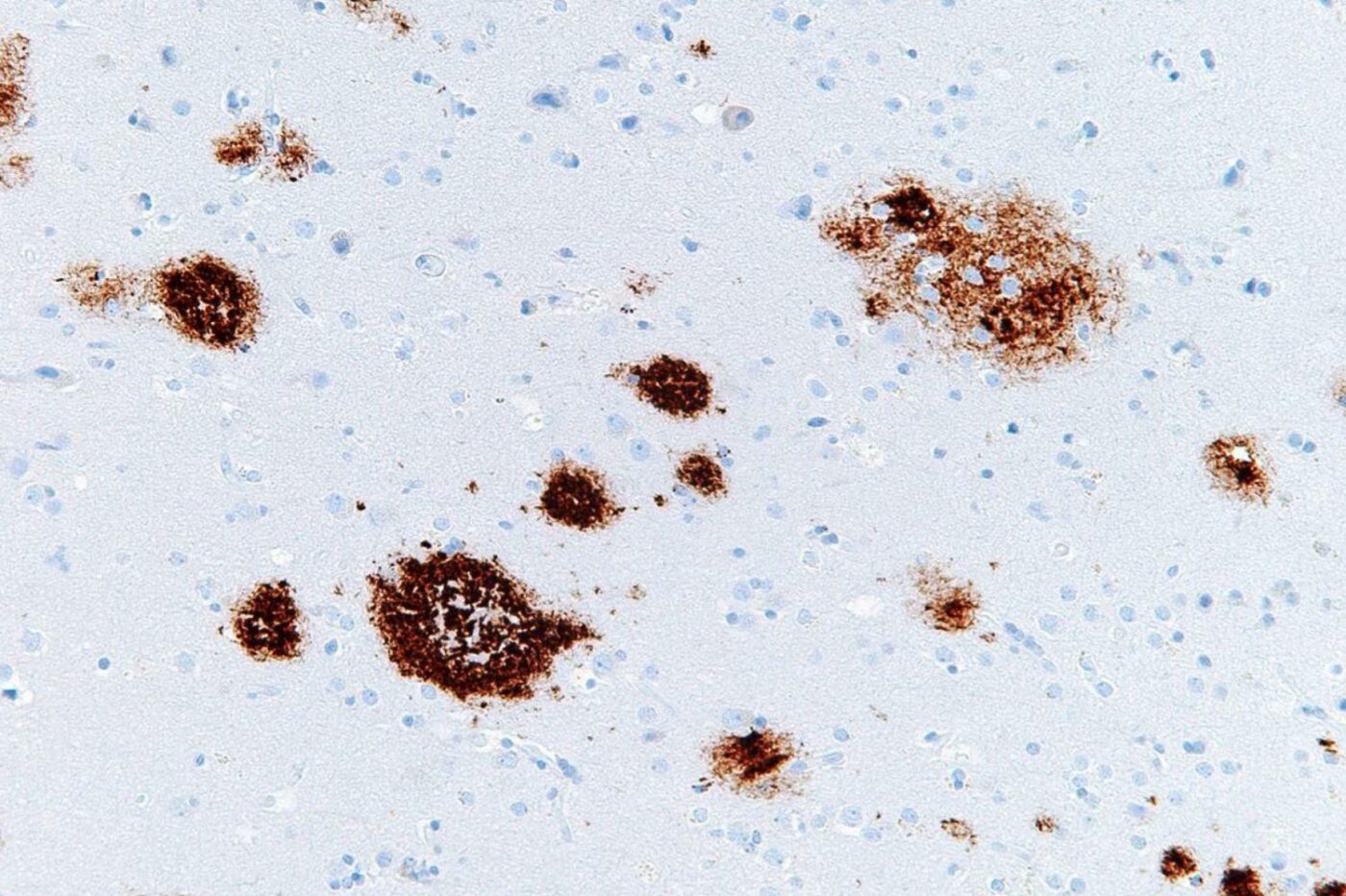 La maladie d’Alzheimer peut se transmettre entre humains, selon une étude